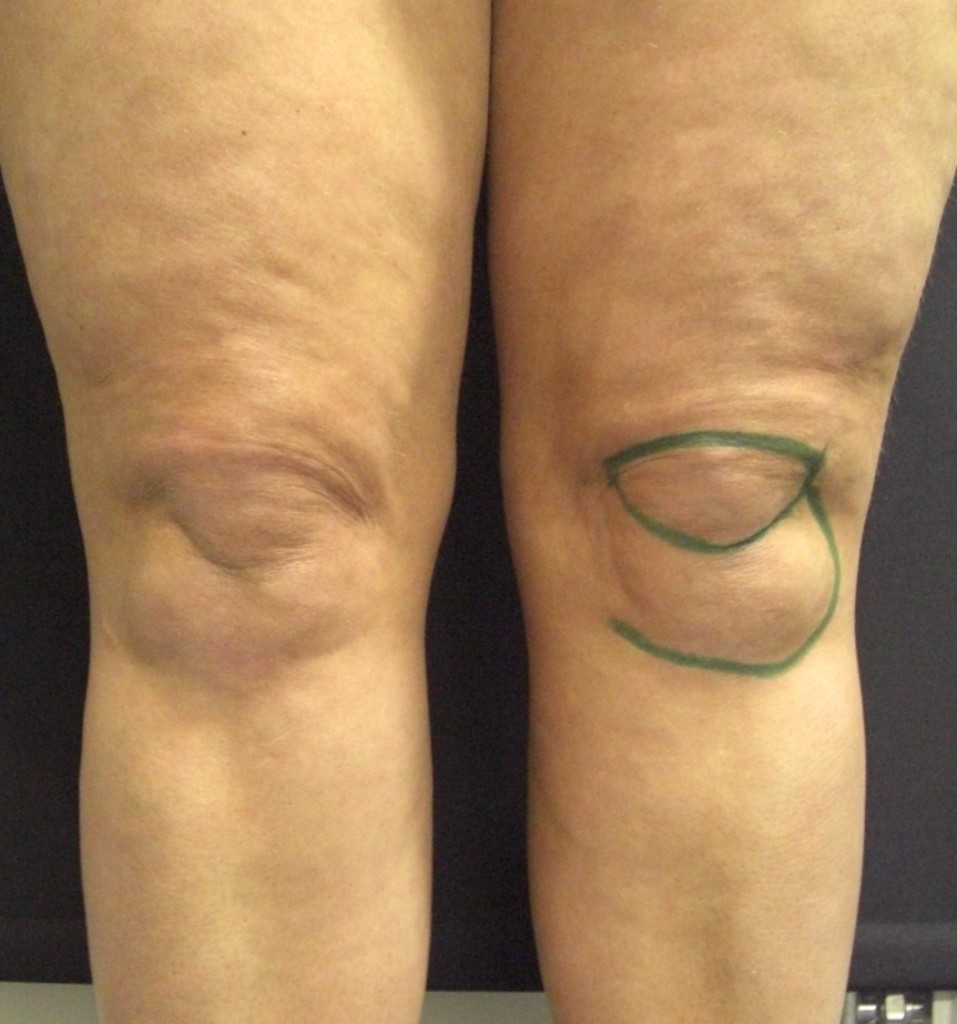 Knee liposuction : sculpting and refining